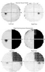 Homonymous Hemianopsia | North American Neuro-Ophthalmology Society