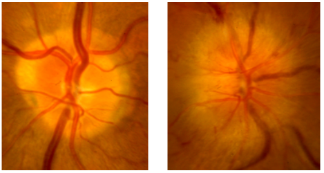 Non-Arteritic Anterior Ischemic Optic Neuropathy | North American Neuro ...